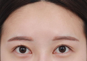 Forehead Lifting in Korea - Made Young Clinic in Gangnam