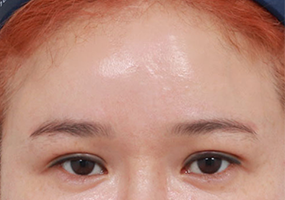Forehead Lifting in Korea - Made Young Clinic in Gangnam