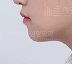 Chin Surgery (Genioplasty) in Korea - Made Young in Gangnam