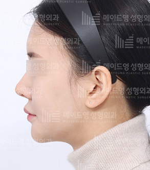 Neck Lift in Korea - Made Young Clinic in Gangnam