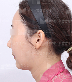 Neck Lift in Korea - Made Young Clinic in Gangnam