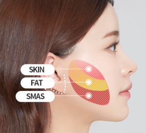 Neck Lift in Korea - Made Young Clinic in Gangnam