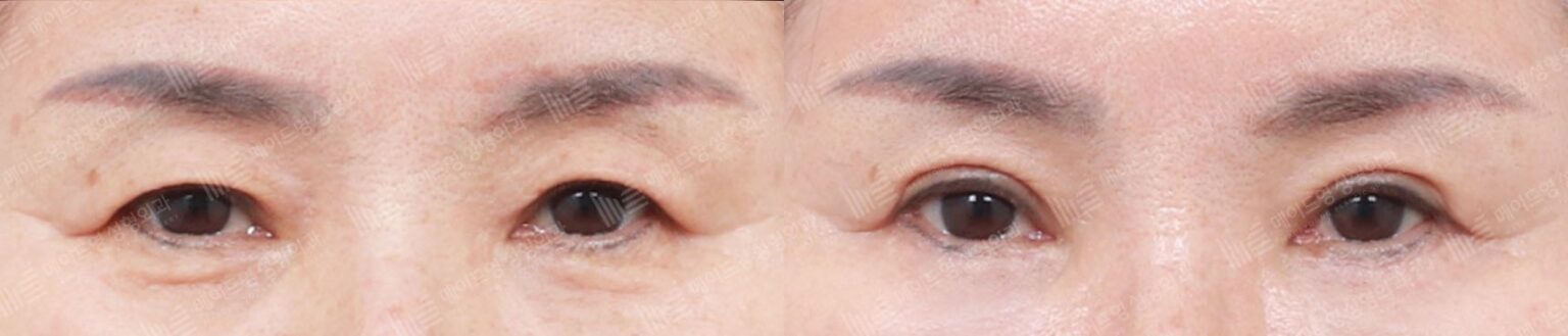 Eye Surgery Before and After - Made Young