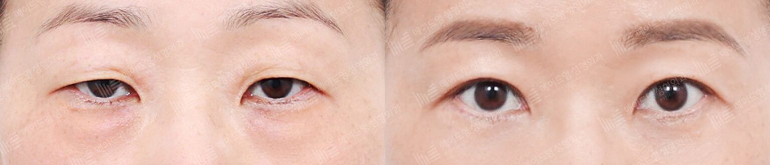 Eye Surgery Before and After - Made Young