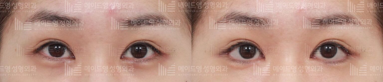 Eye Surgery Before and After - Made Young