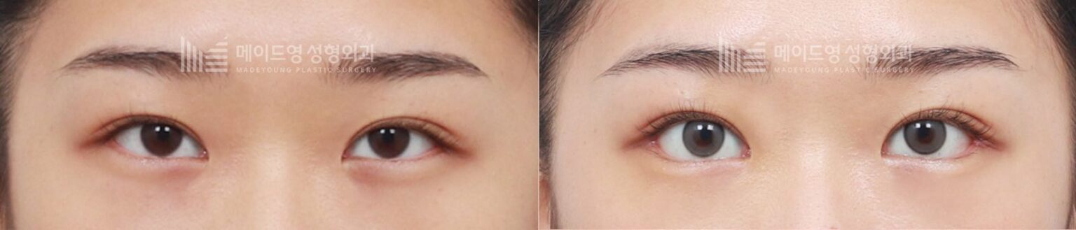 Eye Surgery Before and After - Made Young